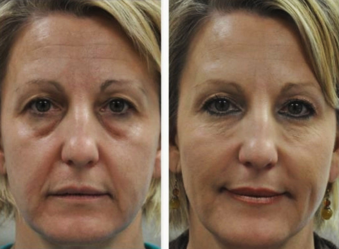 Botox Offer | Beautox Bar