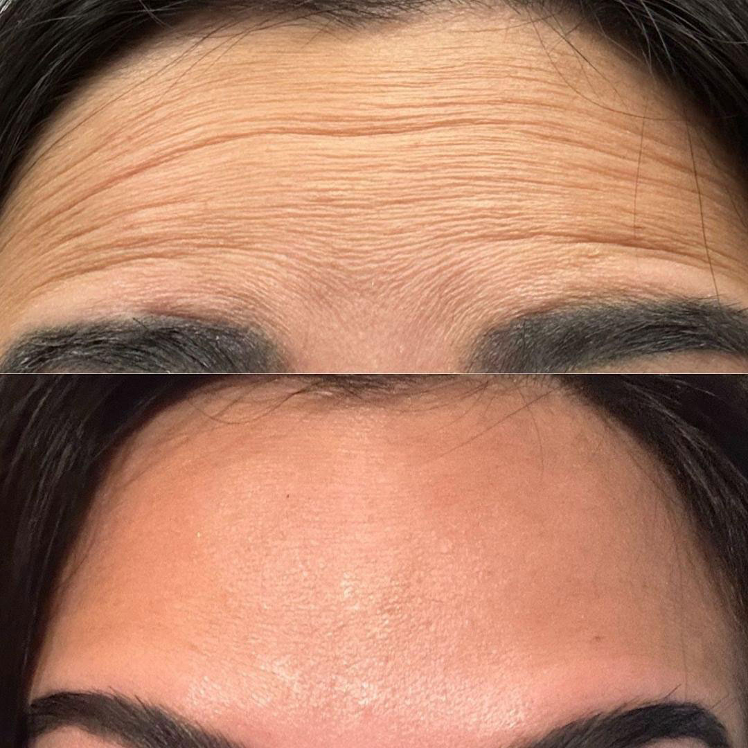 Botox Offer | Beautox Bar